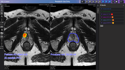 Prostate Cancer - Lucida Medical